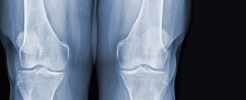 Adductor Canal Block - Maverick Medical Education